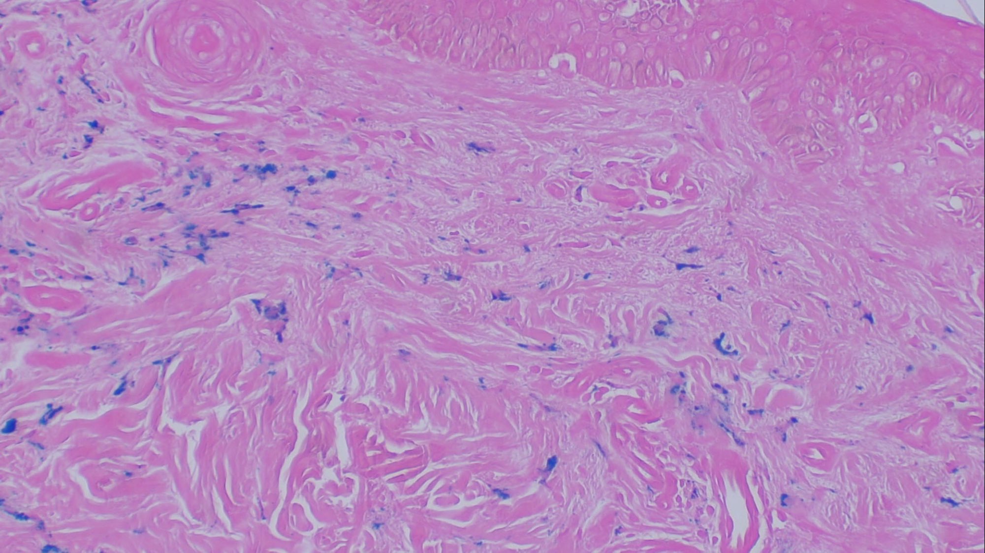 What Is A Desmoplastic Spitz Nevus