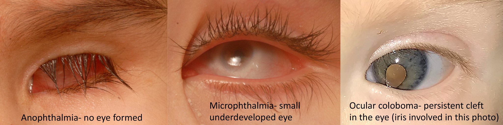 Anophthalmia