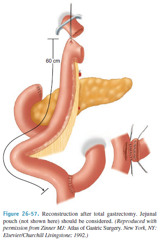 Total Gastrectomy