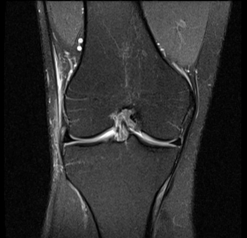 Iliotibial Band Syndrome Mri