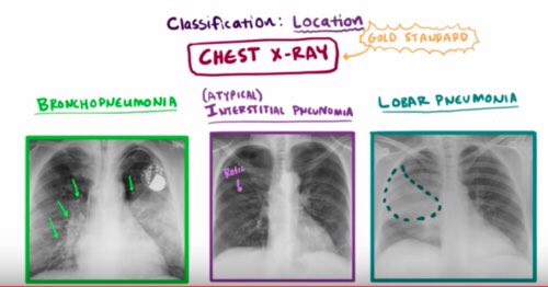 Interstitial Pneumonia X Ray
