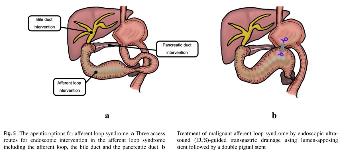 Roux En Y Afferent Limb