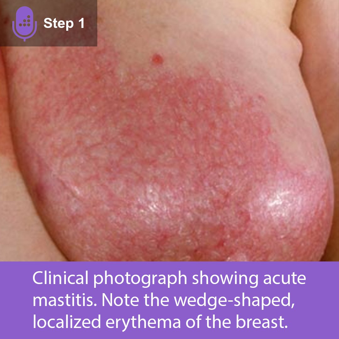 Acute Mastitis PDF] Acute Mastitis Caused By Pasteurella Multocida In
