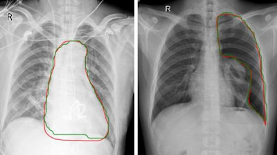 Radiology: Artificial Intelligence on Twitter: "#DeepLearning models accurately detected ...