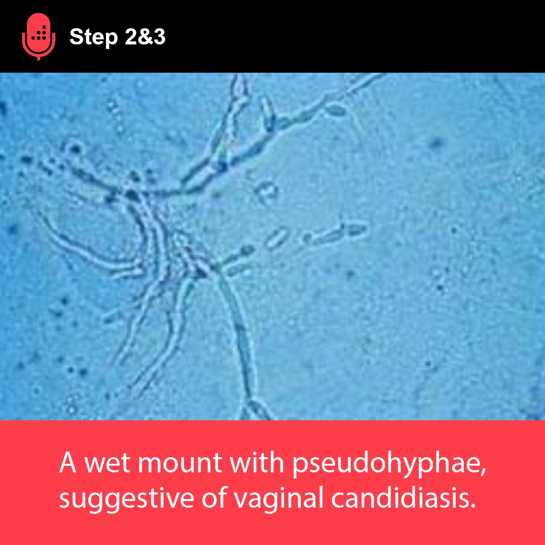 Vulvovaginal Candidiasis Wet Mount