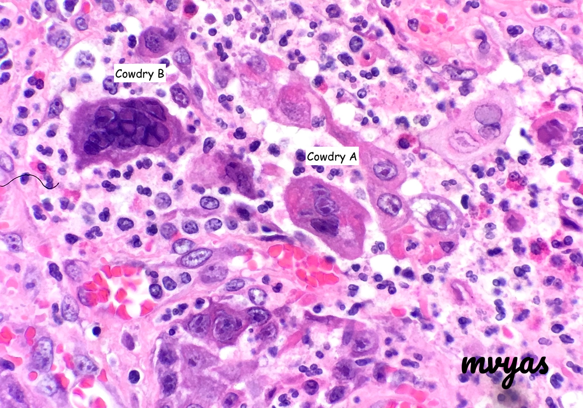 Cowdry Type B Inclusion Bodies