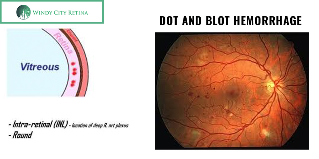 Dot And Blot Hemorrhages
