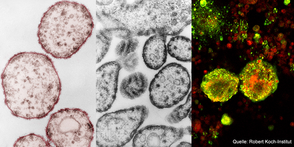 Measles Virus Under Microscope