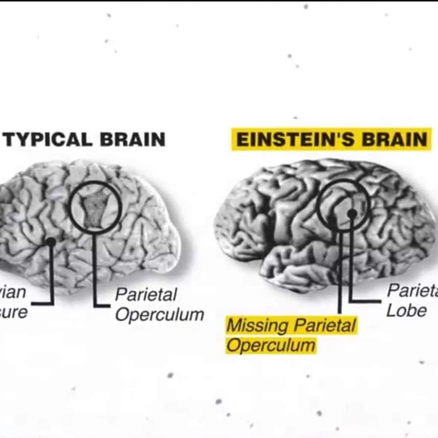 Einstein Brain Vs Normal Brain Einstein Brain Vs Normal Brain