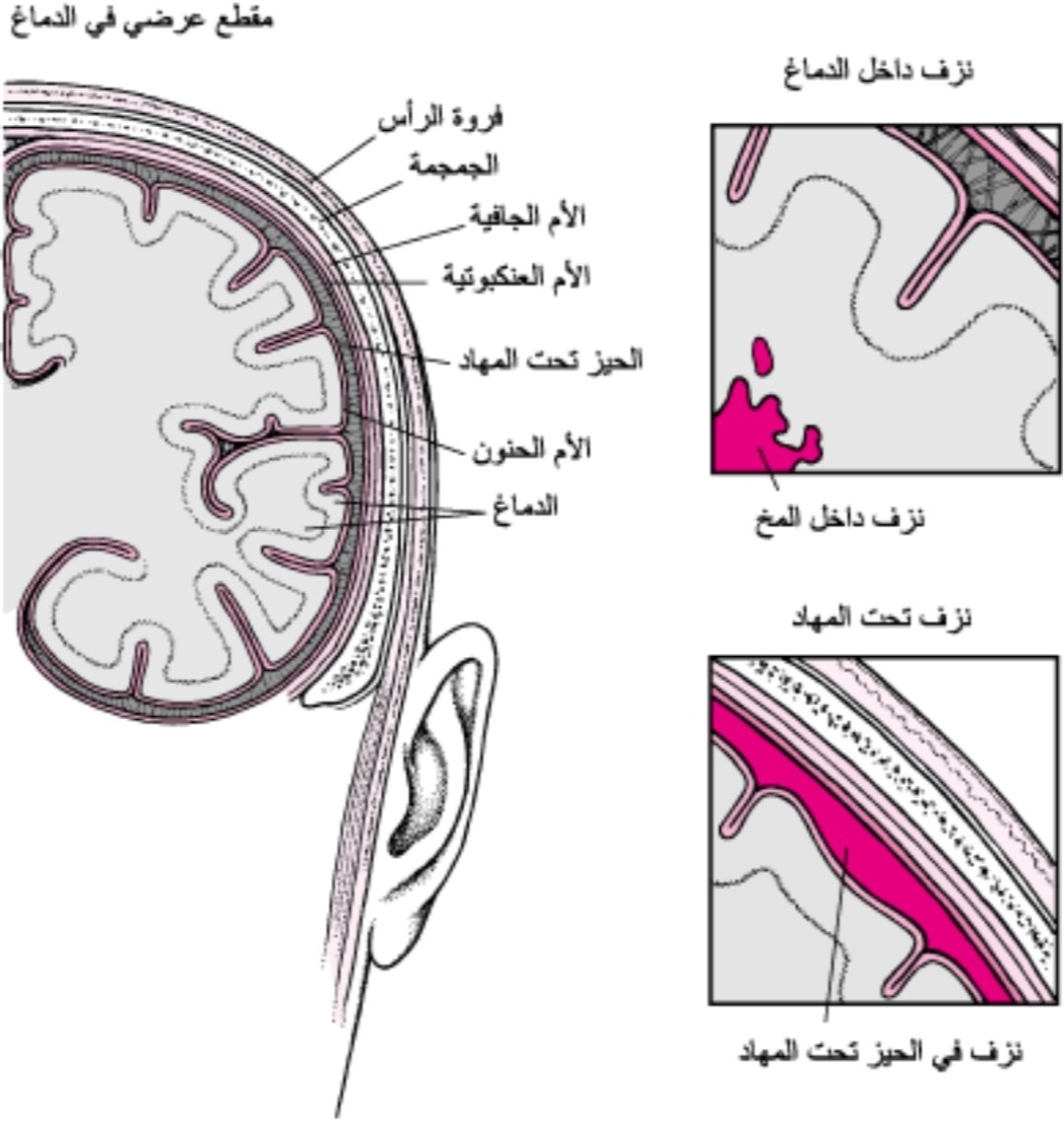 ساخصص هذا الثريد للحديث عن السكته الدماغيه جلطات المخ ساشارككم أهم