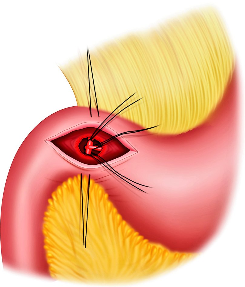 Bleeding Duodenal Ulcer