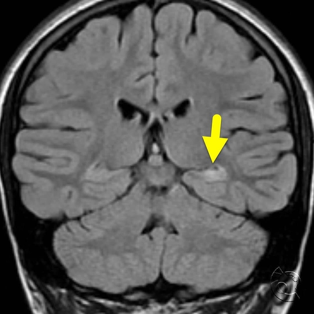 Medial Temporal Lobe Epilepsy