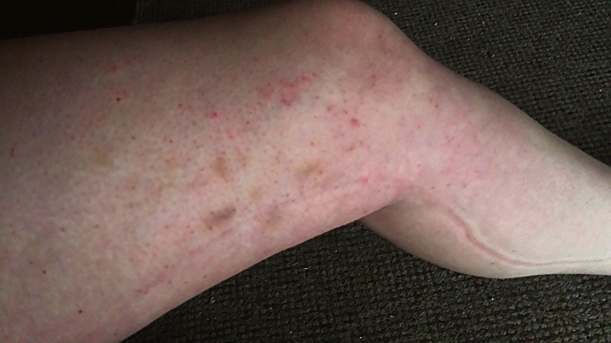 Kill Bird Mites On Humans