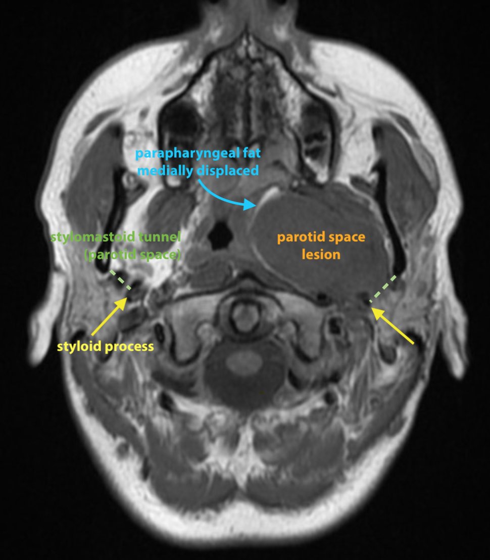 Parotid Space