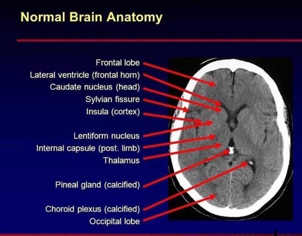 Anatomía Cerebral Normal Normal Anatomy Of Human Brain Vintage