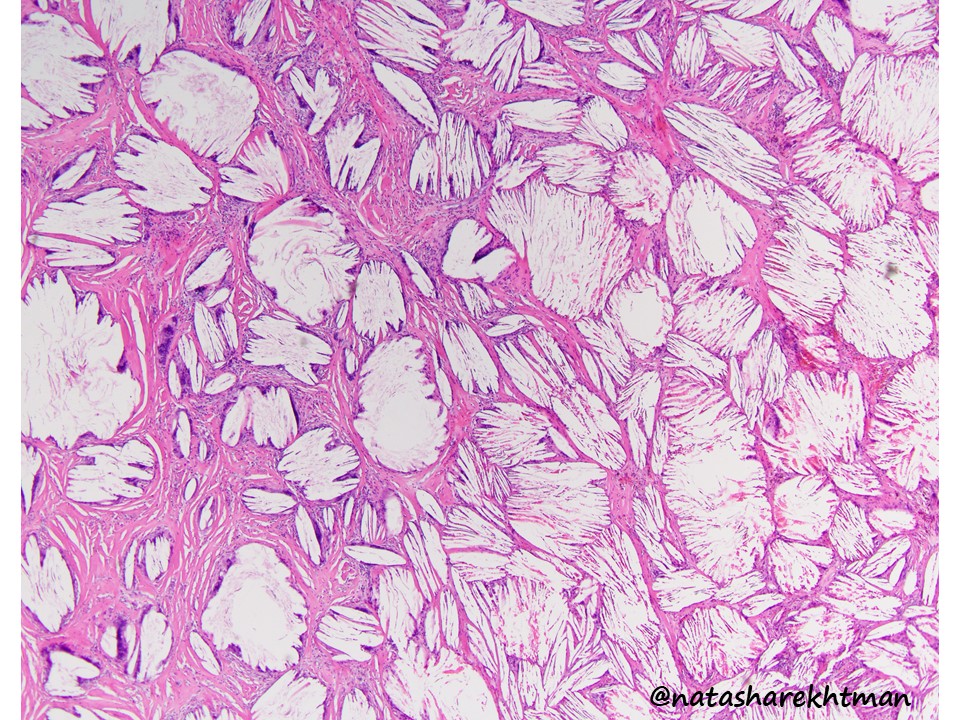 Sclerema Neonatorum Pathology