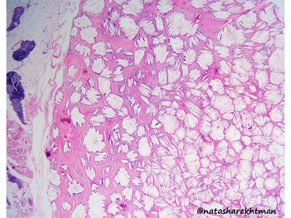Sclerema Neonatorum Pathology