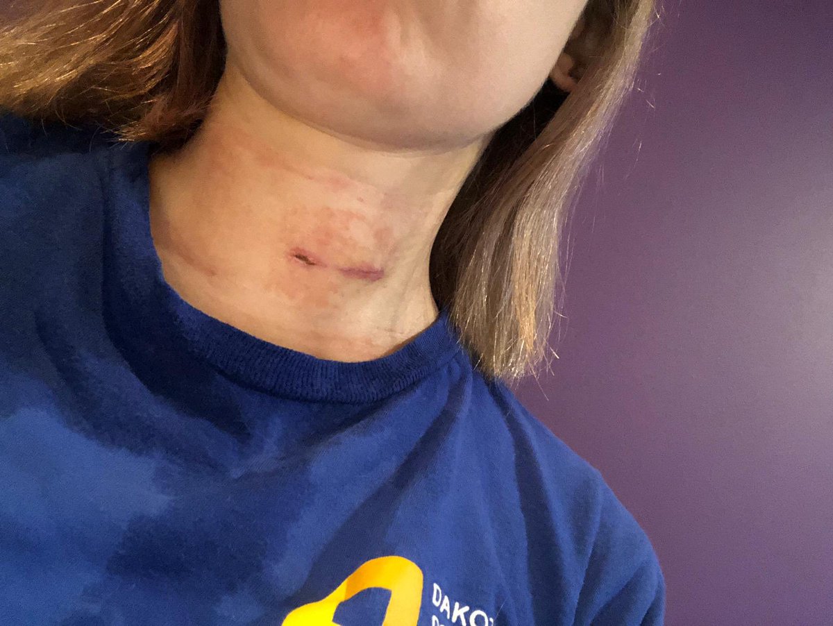 Discectomy Scar Neck