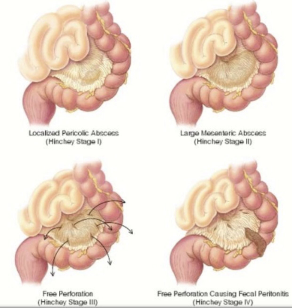 DR AFTAB AHMED On X: Modified Hinchey Classification For, 46% OFF