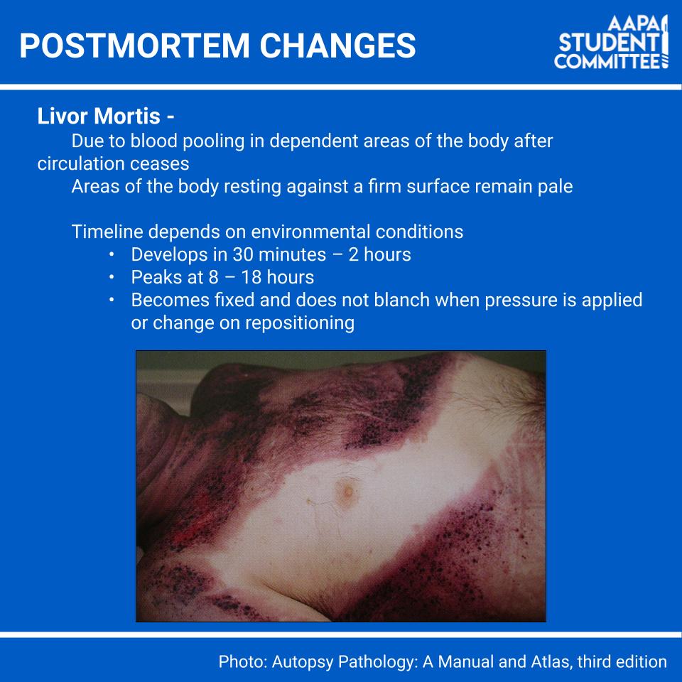 Livor Mortis Forensics
