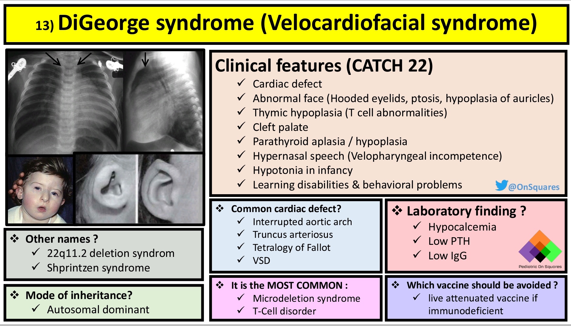 Digeorge Syndrome Facial Features