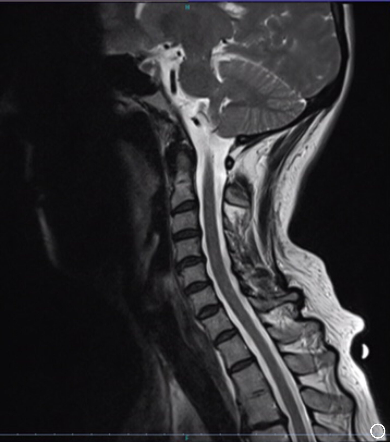 X Rayed Upper Back Hump