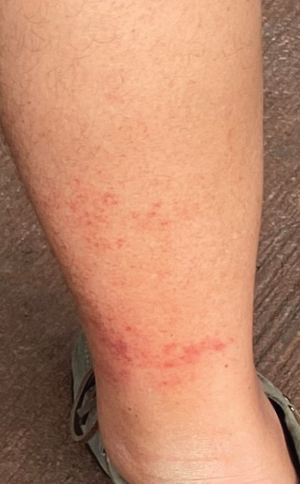 Mild Petechiae Legs