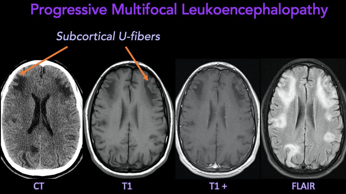 Progressive Multifocal Leukoencephalopathy Mri