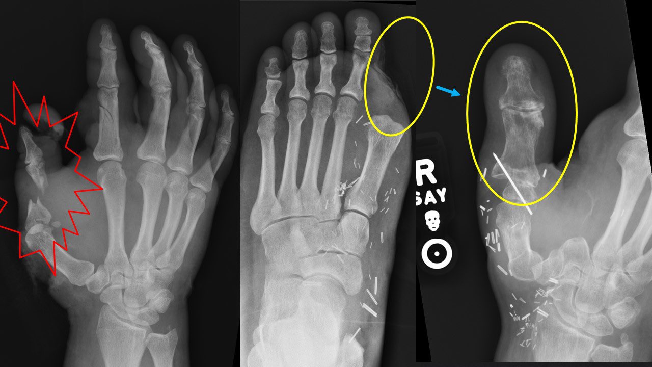 Great Mcp Joint Of Toe