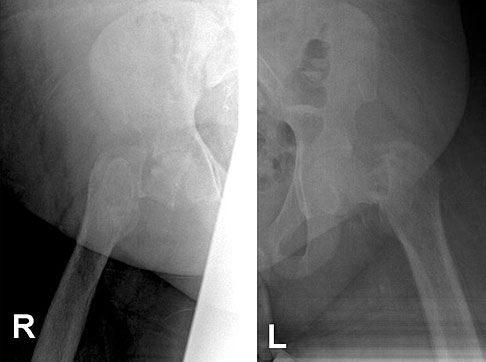 Osteomalacia Basic Science Orthobullets Bone Healing | PPT