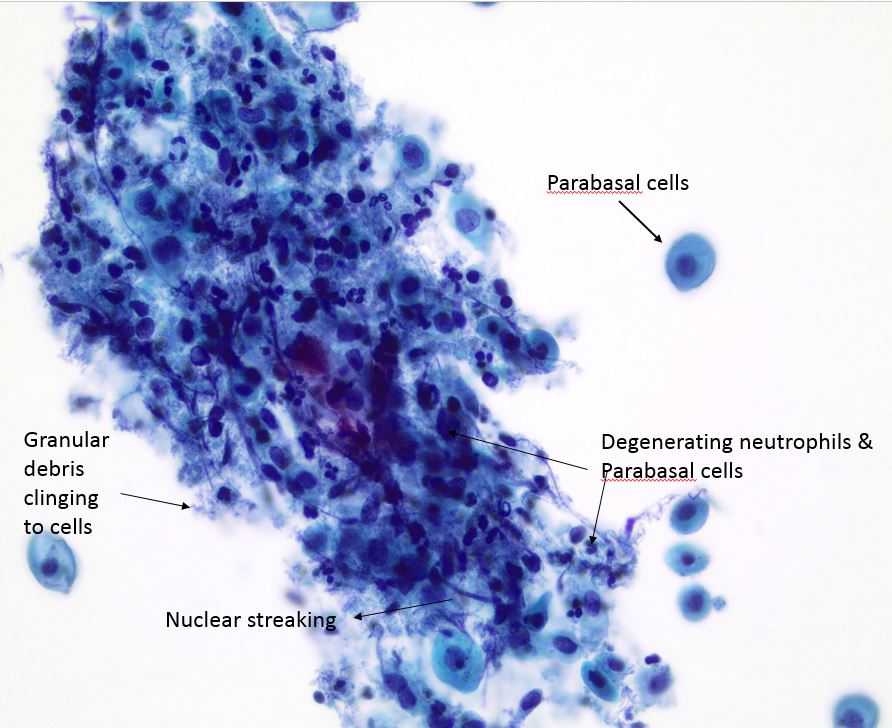 Atrophic Vaginitis Cytology