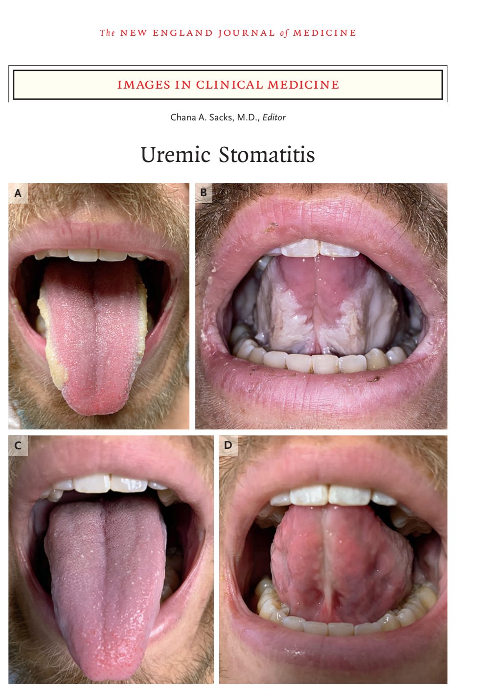 Uremic Stomatitis