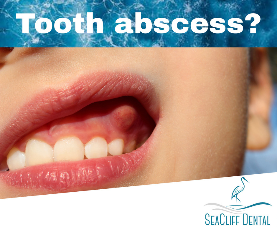 Abscessed Front Tooth