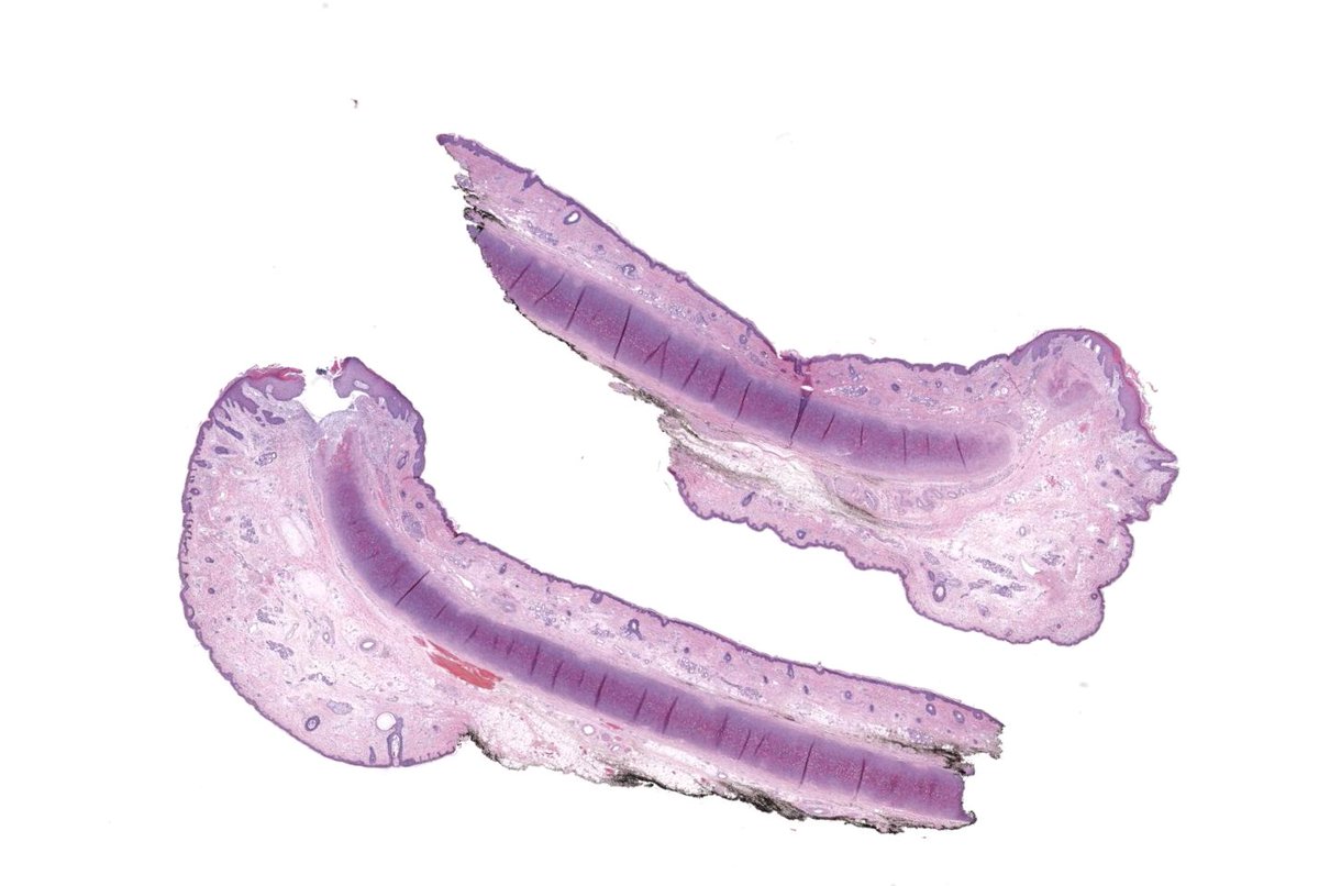 Chondrodermatitis Nodularis Helicis Histology
