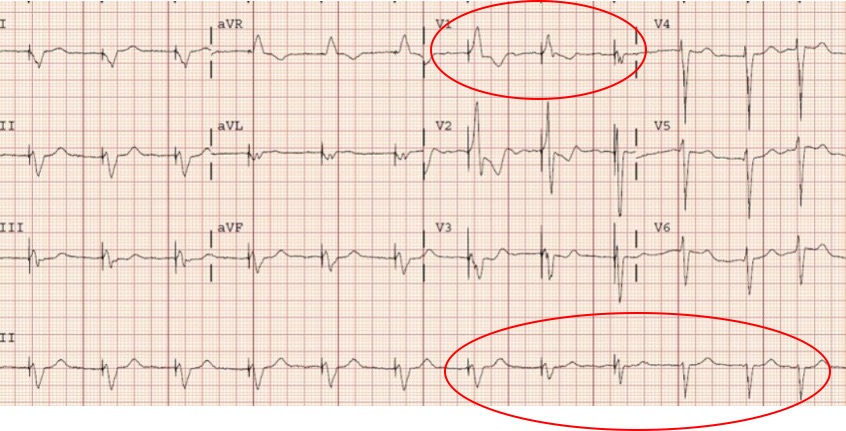 Biventricular Pacemaker Rhythm Strip