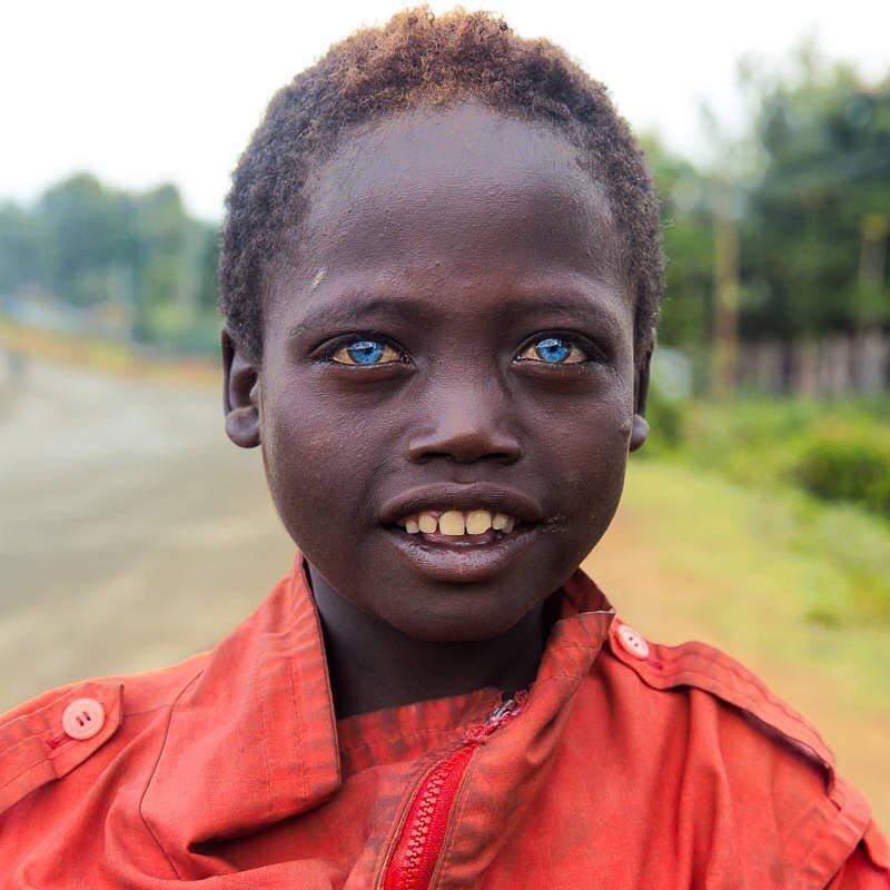 People Born With Red Eyes