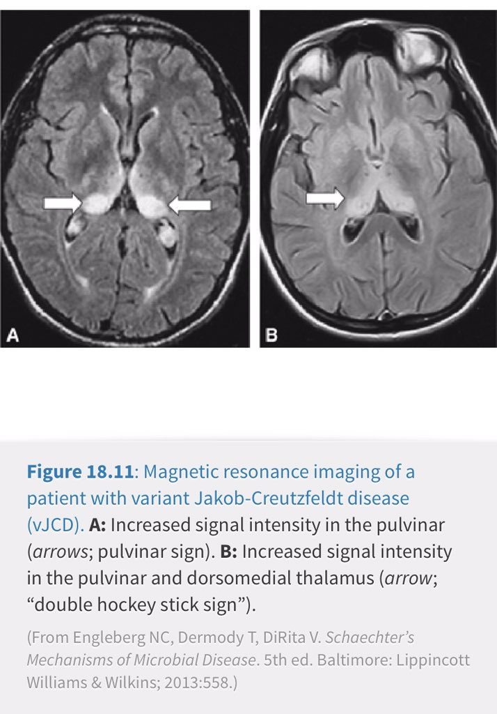 Hockey Stick Sign (Creutzfeldt-Jakob Disease) at Loriann Day blog