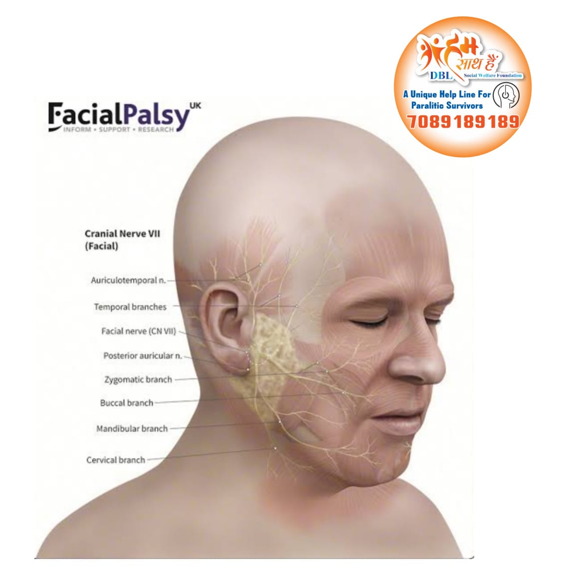 Palpebral Fissure Diagram