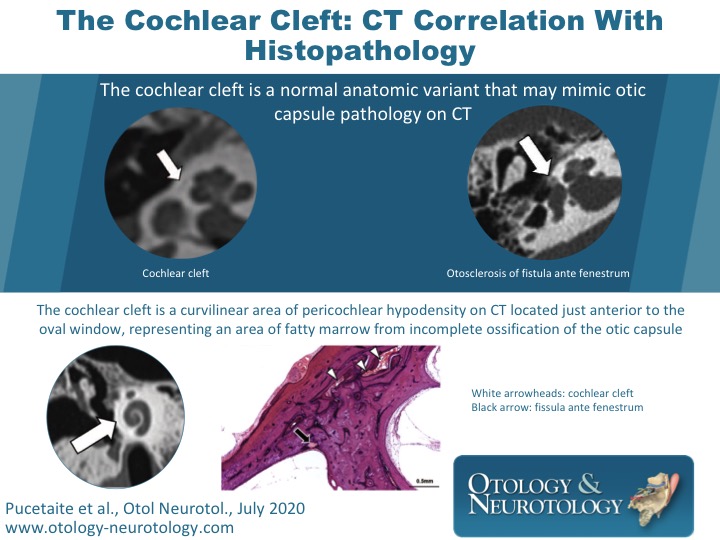 Otosclerosis Histology