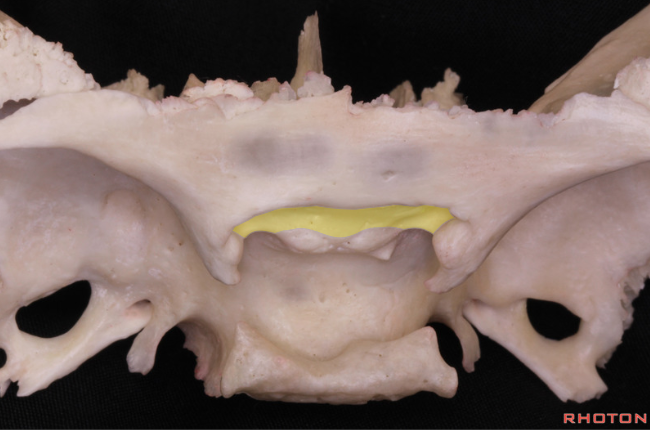 Sella Turcica Of Sphenoid