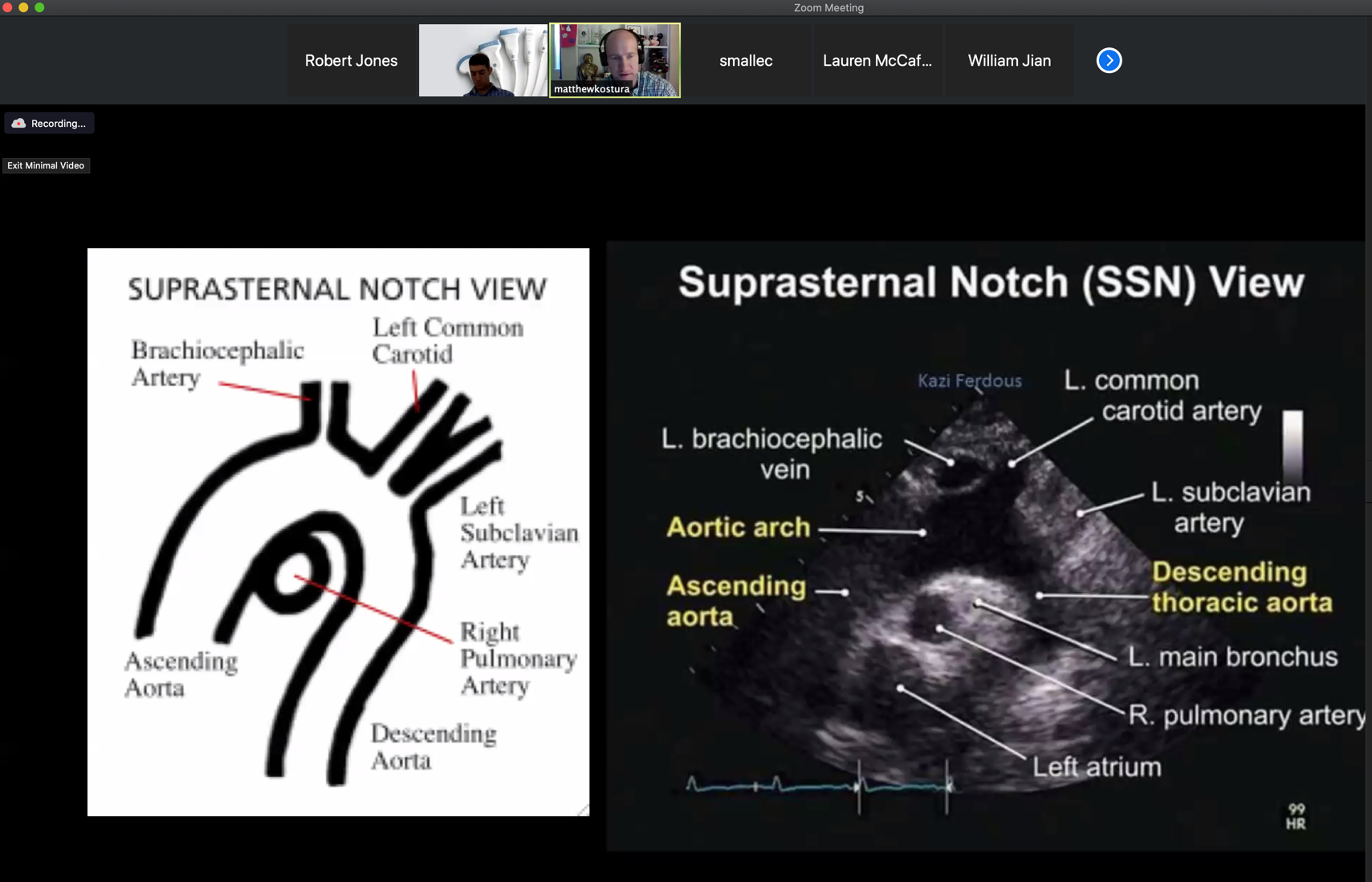 Suprasternal Notch