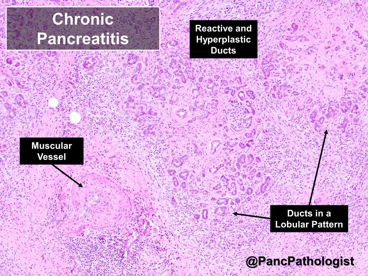 Chronic Pancreatitis Histology