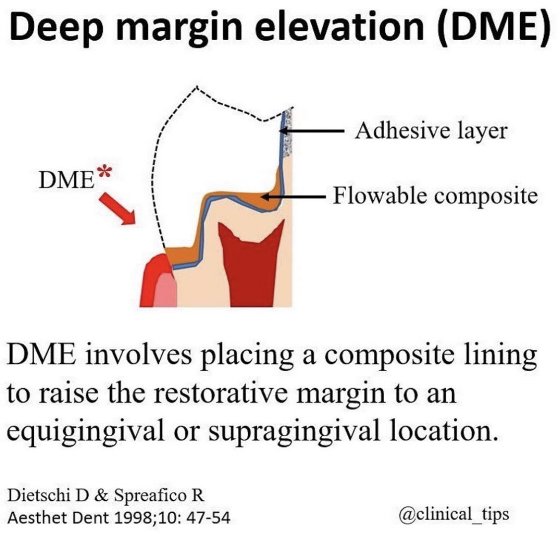 Gingival Margin Elevation Deep Margin Elevation And Clinical Crown