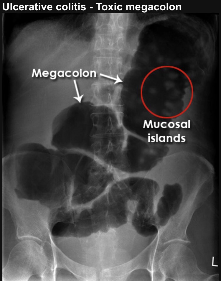 Toxic Megacolon Radiology