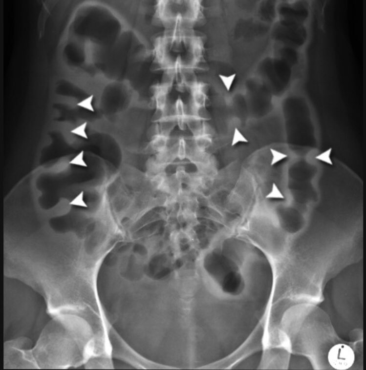 Toxic Megacolon X Ray