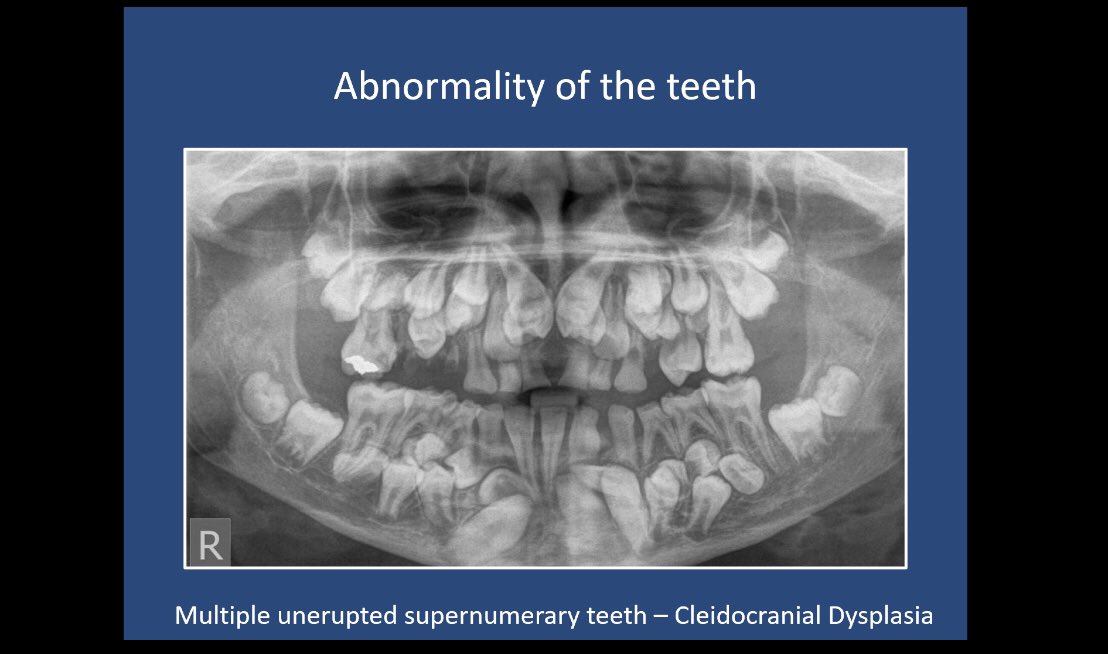Supernumerary Teeth Xray