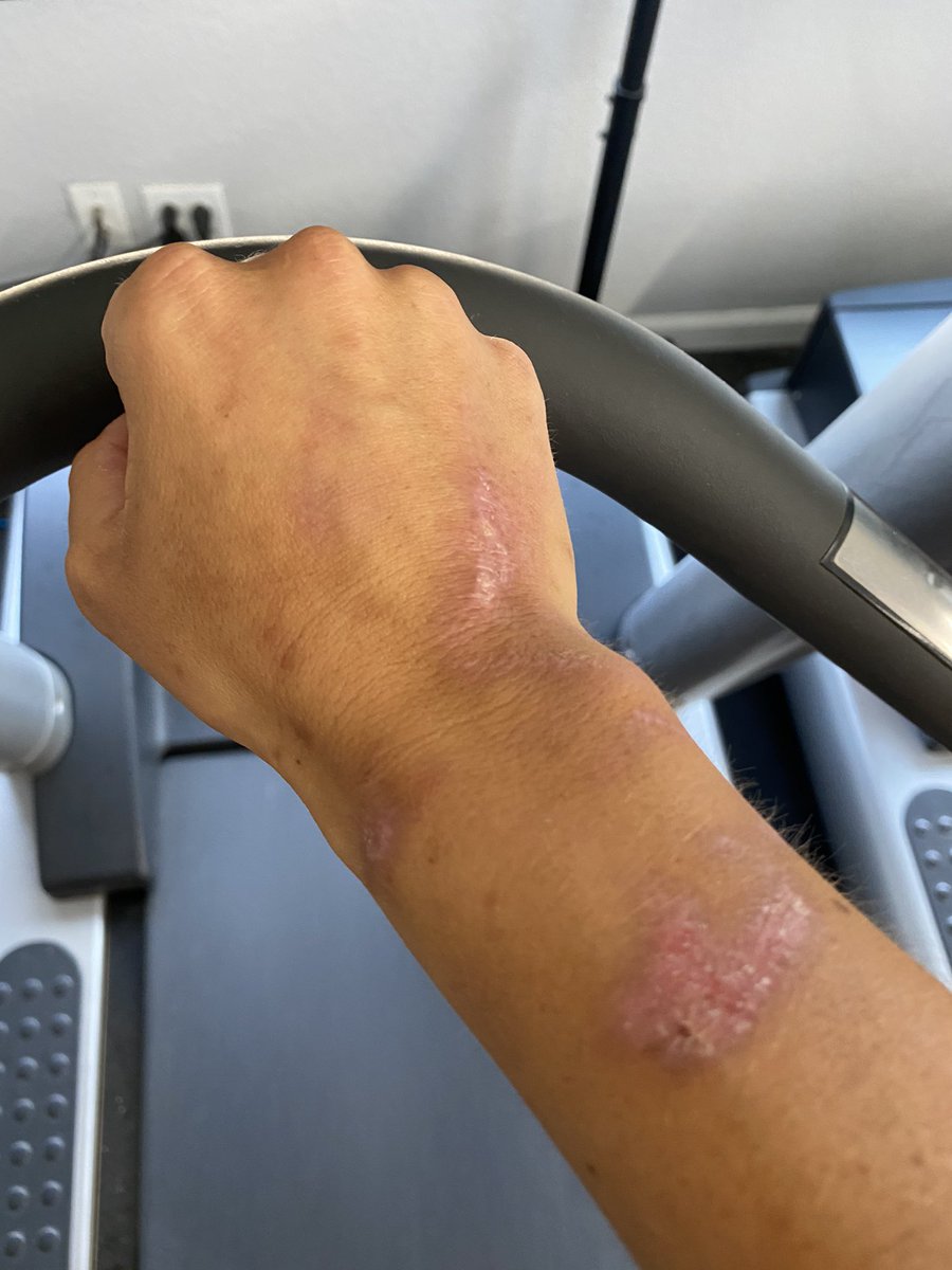 Catfish Noodling Injuries