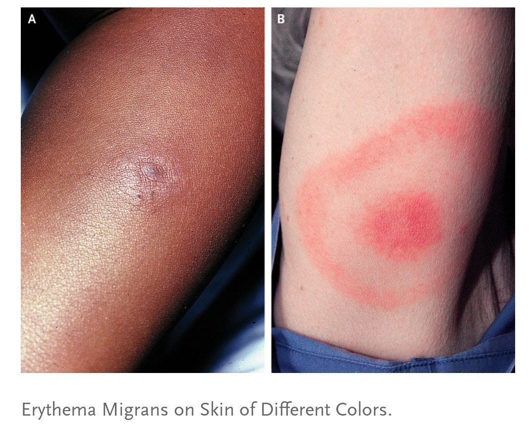 Erythema Chronicum Migrans