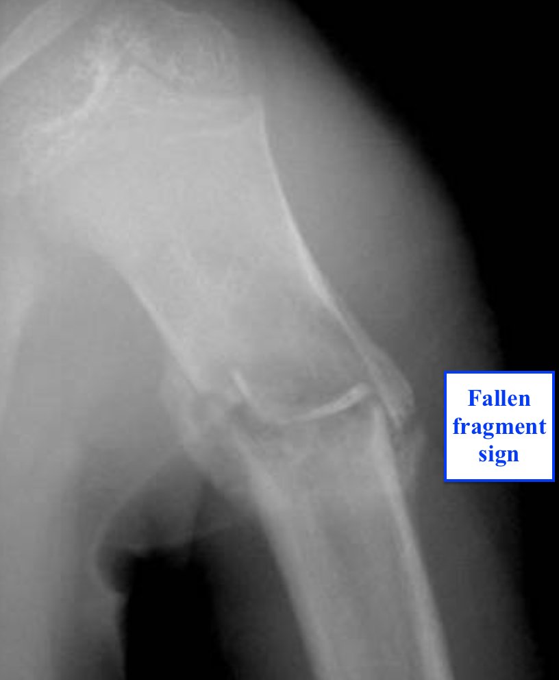 Simple Bone Cyst Fallen Fragment Sign