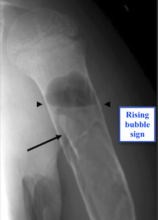 Simple Bone Cyst Fallen Fragment Sign